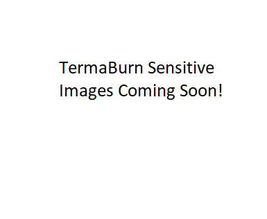 TermaBurn Sunburn Relief Wrap - Aloe Vera Soothing Pad